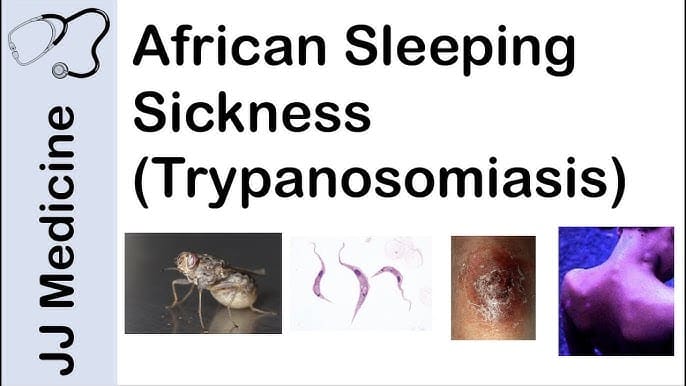 Human African trypanosomiasis (sleeping sickness): Parasitic disease ...