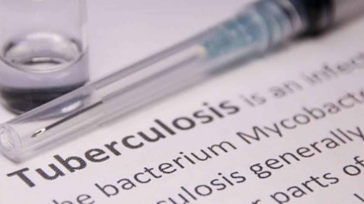 Shorter TB Treatments Prove Cost-Effective in New Study - Observer Voice