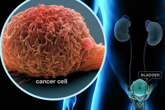 Bladder Cancer: Early Signs, Risk Factors, and What Smoking Has to Do ...
