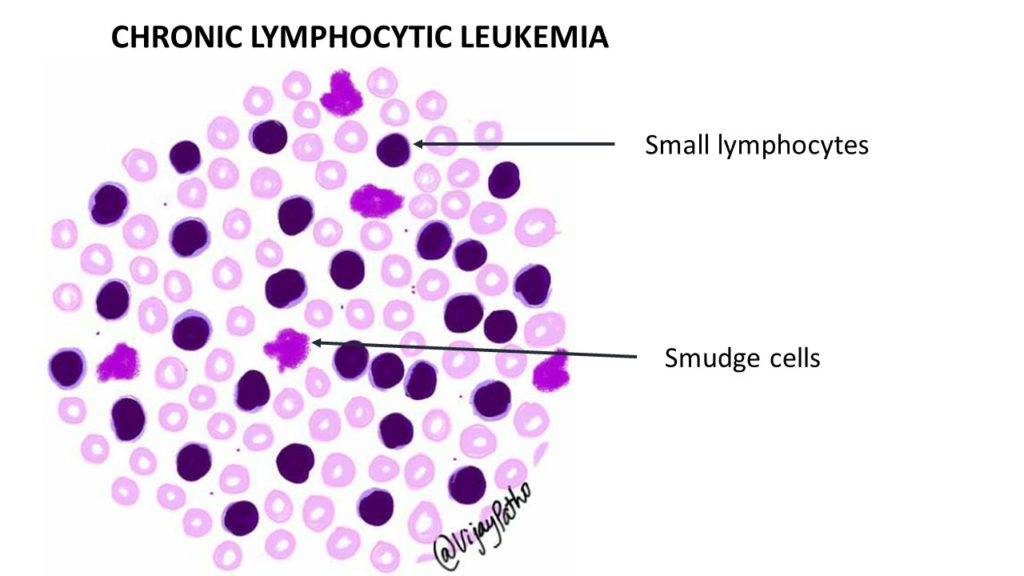 Chronic Lymphocytic Leukemia (CLL): What to Expect After Diagnosis ...