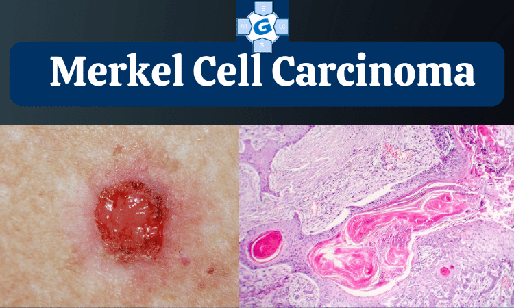 Merkel Cell Carcinoma: The Rare and Aggressive Skin Cancer You Should ...