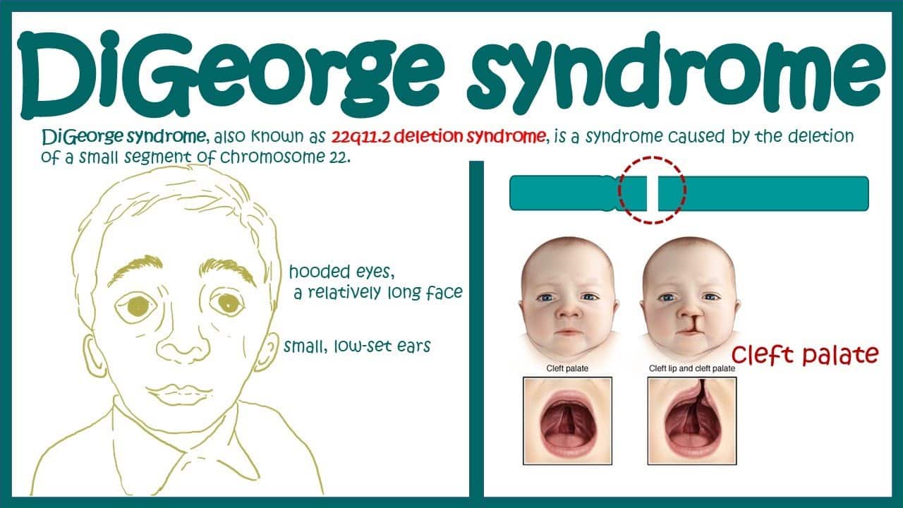 22q11.2 Deletion Syndrome (DiGeorge): Heart Defects, Immunity, and ...