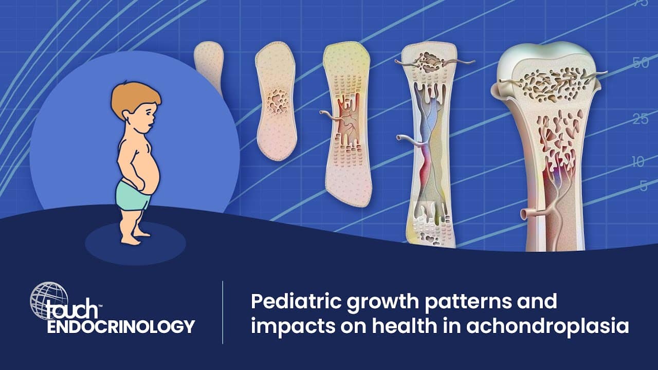Achondroplasia: The Most Common Form of Short-Limbed Dwarfism Explained ...