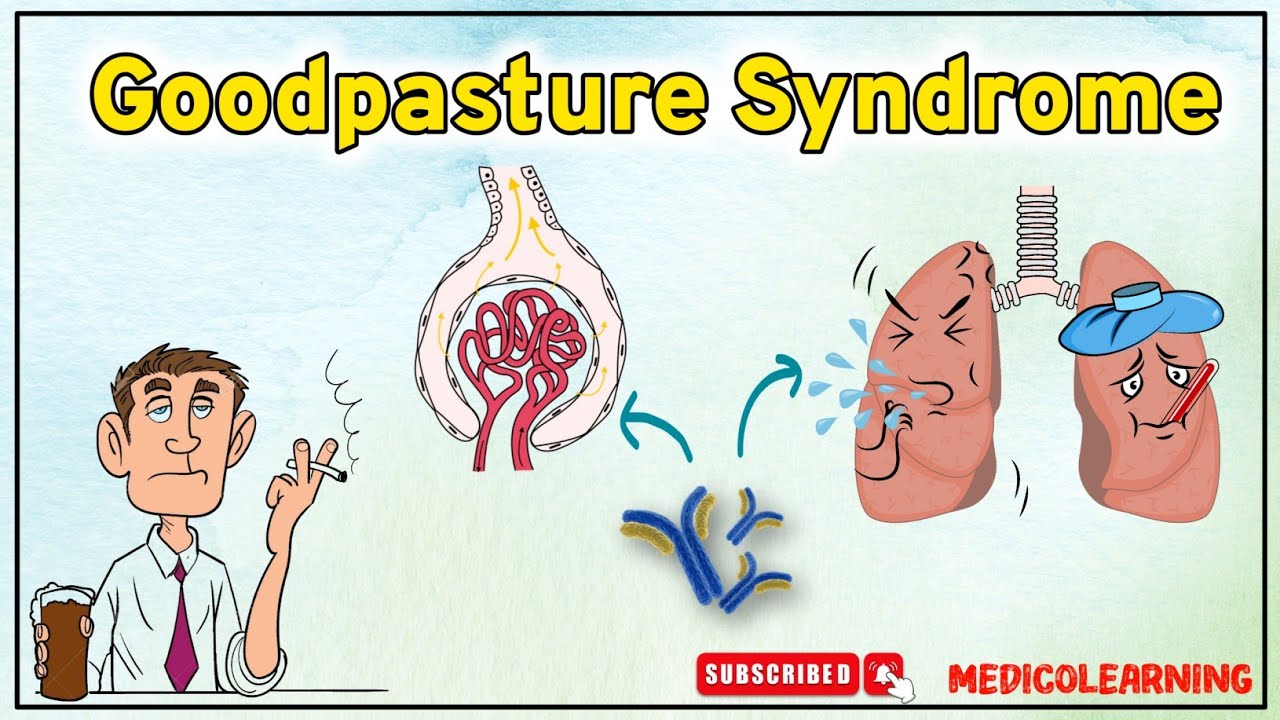 Goodpasture Syndrome: When Antibodies Attack Both the Lungs and Kidneys ...