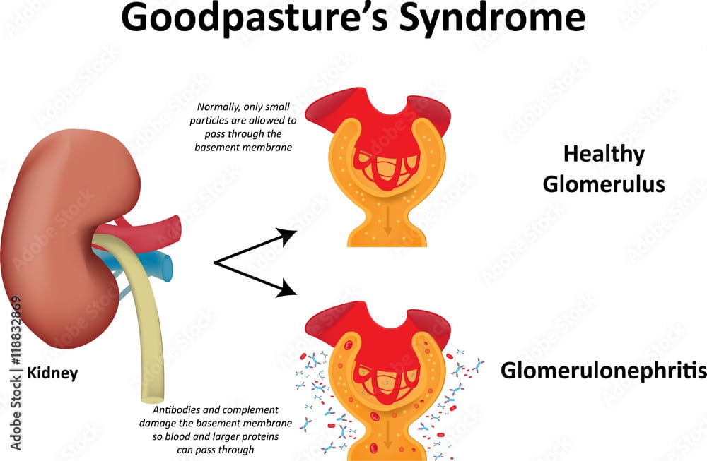 Goodpasture Syndrome: When Antibodies Attack Both the Lungs and Kidneys ...