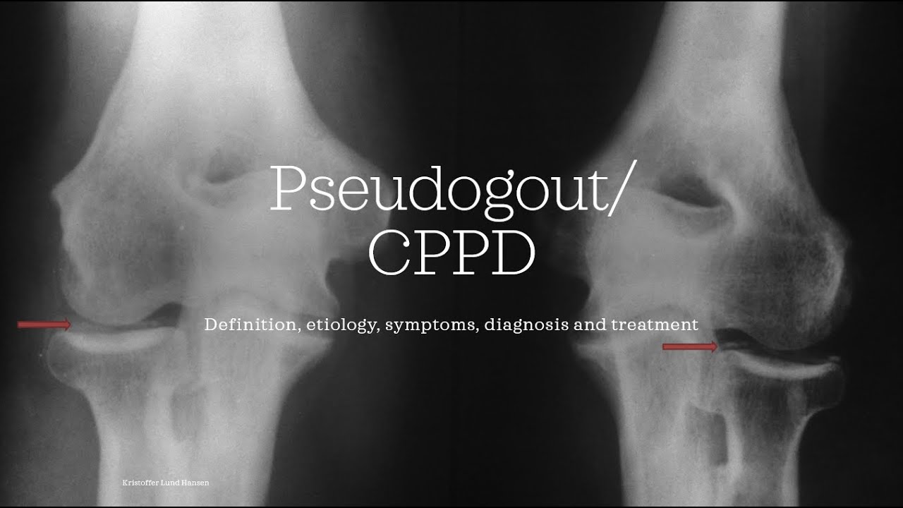 Pseudogout (CPPD Disease): When Calcium Crystals Mimic Gout - Observer ...