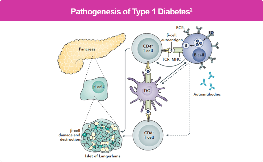 Type 1 Diabetes: Autoimmune Destruction of the Pancreas From Day One ...
