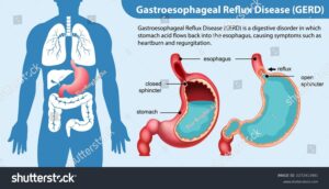 Gastroesophageal Reflux Disease (GERD): Beyond Heartburn ...