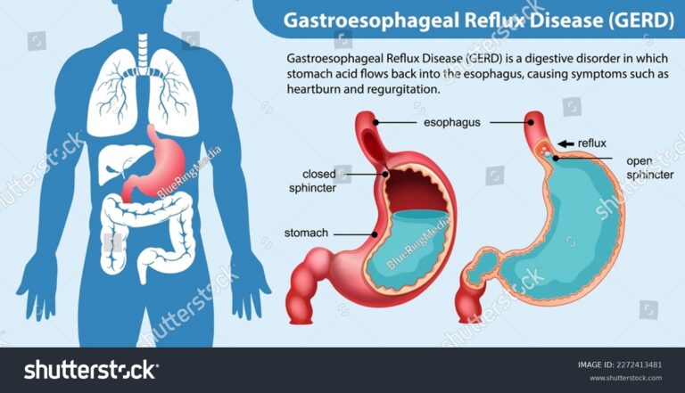 Gastroesophageal Reflux Disease (GERD): Beyond Heartburn ...